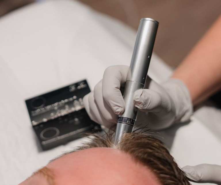 Revitalize Your Hair with Exceed Medical Microneedling: A Comprehensive ...